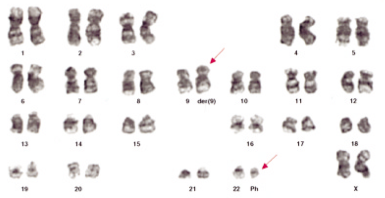 Chronic Myeloid Leukemia: a Molecular Diagnosis | Common Science Space